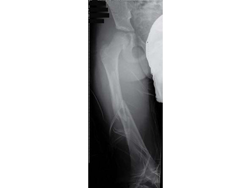 Elastic Nail in Titanium (TEN) and Steel (STEN)