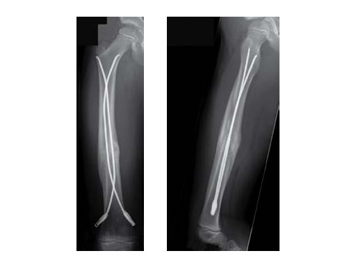 Elastic Nail in Titanium (TEN) and Steel (STEN)