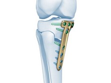 TomoFix Medial High Tibia