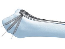 Variable Angle LCP Distal Radius System 2.4