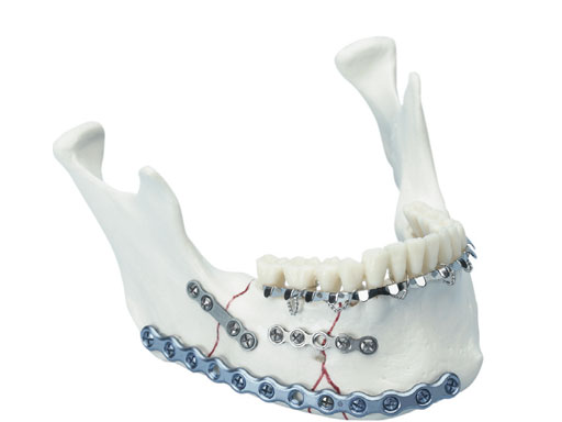 Matrix Mandible System