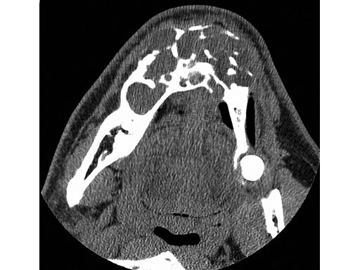 Matrix Mandible System