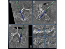 Computer assisted surgery for spinal instrumentation
