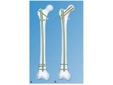 Expert Asian Femoral Nail (A2FN)