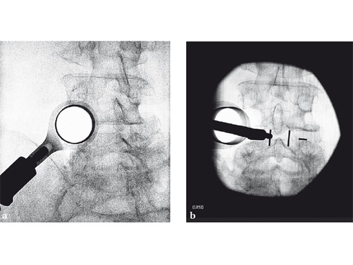 Insight Retractor and Tube Systems