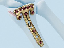 2.4 mm VA-LCP Volar Rim Distal Radius Plate