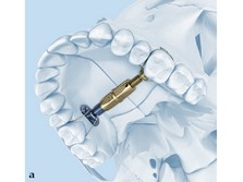 Transpalatal Distractor System