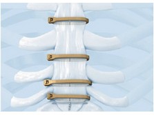 Sternal Zipfix System