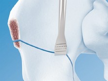 Hip Preservation Surgery Set