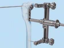 New Mini Tibia Leveling Osteotomy (TPLO) Jig