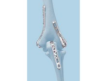 VA-LCP Elbow Plating System