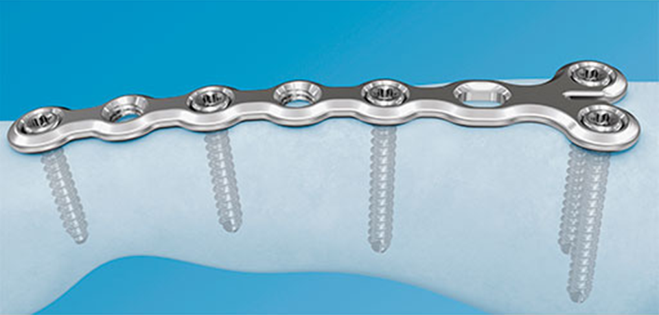 Locking Compression Plate 1.5 System