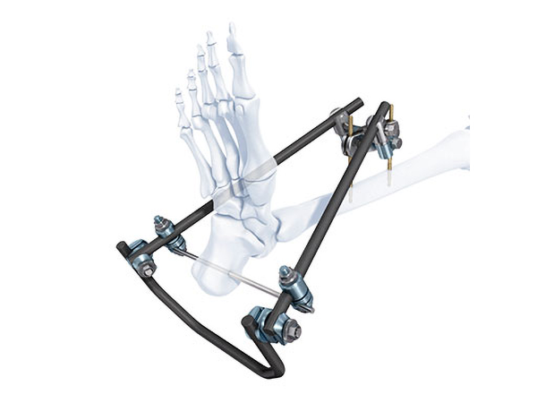 Bridging Rods for External Fixation