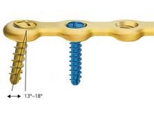 Locking Reconstruction Plate 2.4 and Mini Plate 2.0 System