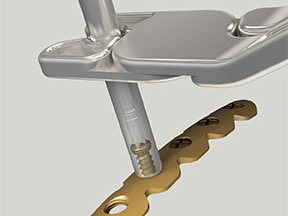 MatrixRIB - Minimally Invasive Plate Osteosynthesis