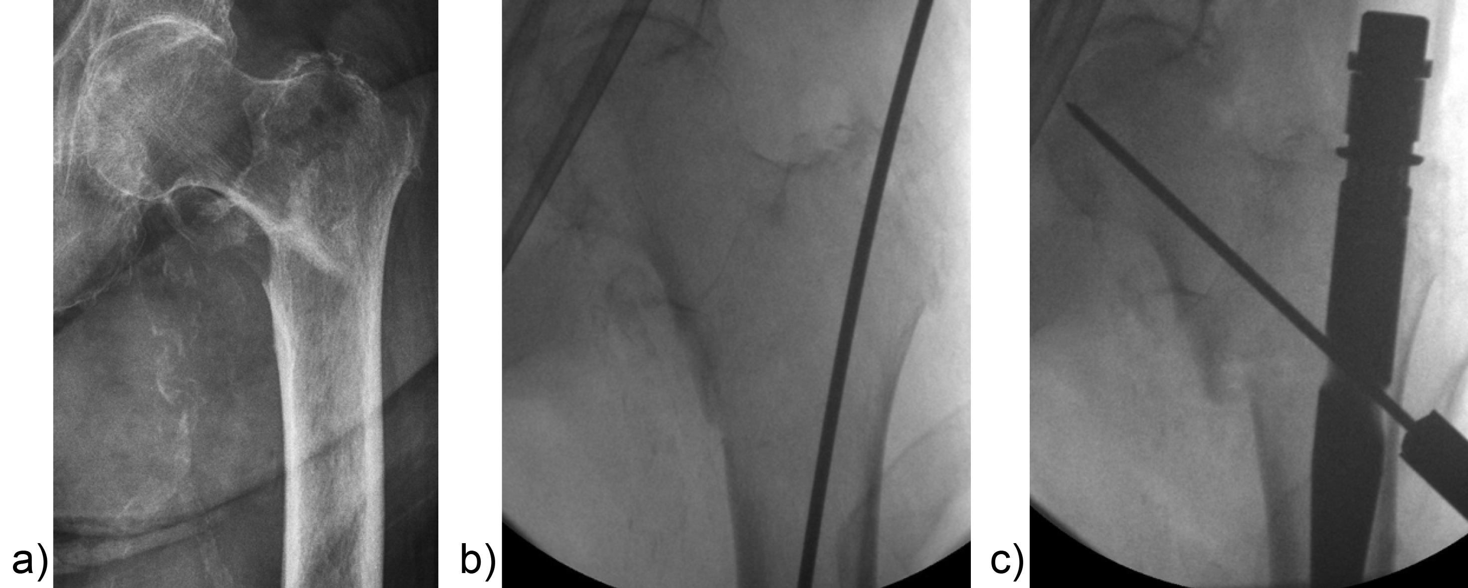 TFN-ADVANCED Proximal Femoral Nailing System (TFNA)