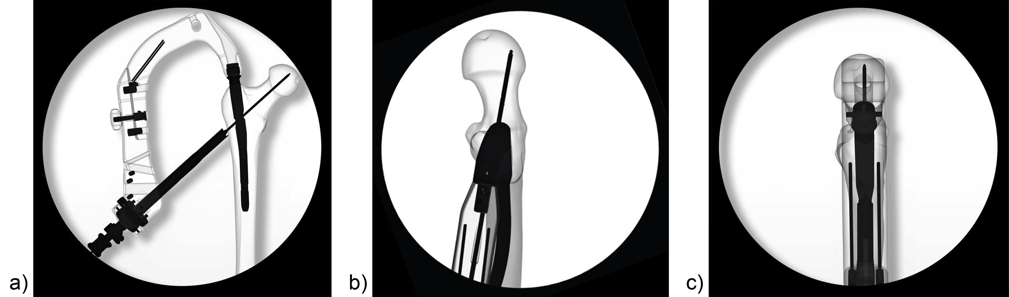 TFN-ADVANCED Proximal Femoral Nailing System (TFNA)