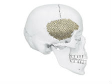 MatrixNEURO Preformed Mesh