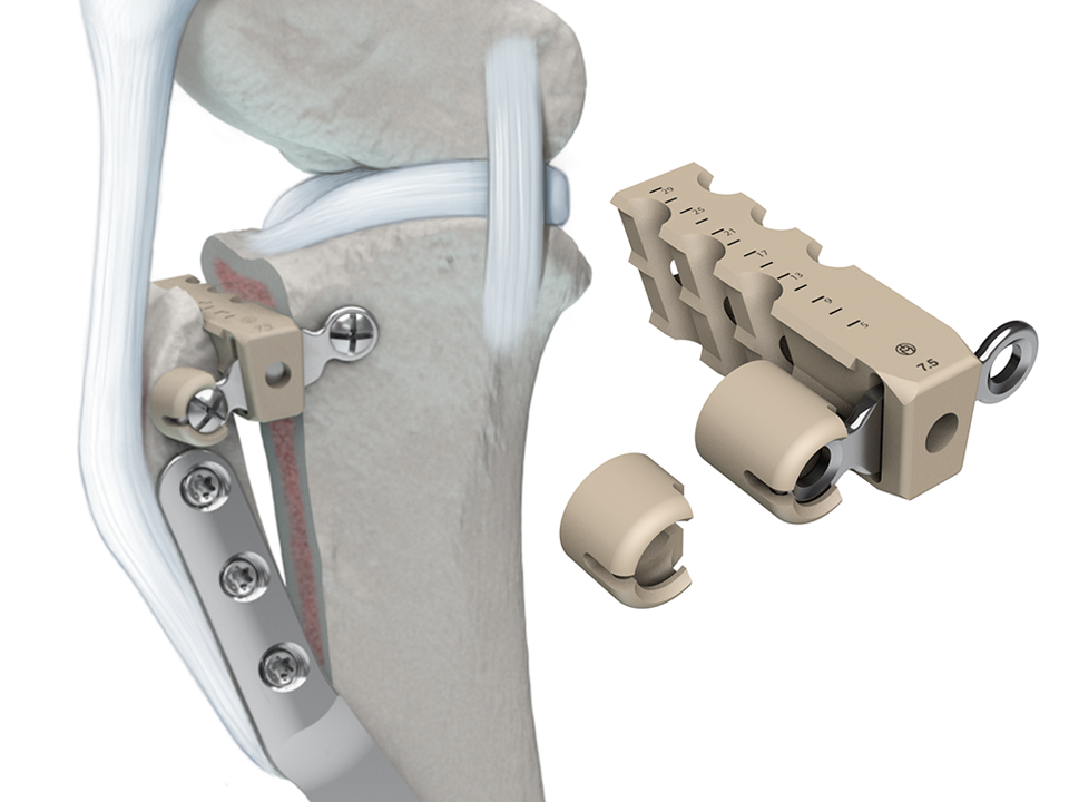 Tibial Tuberosity Advancement (TTA) System