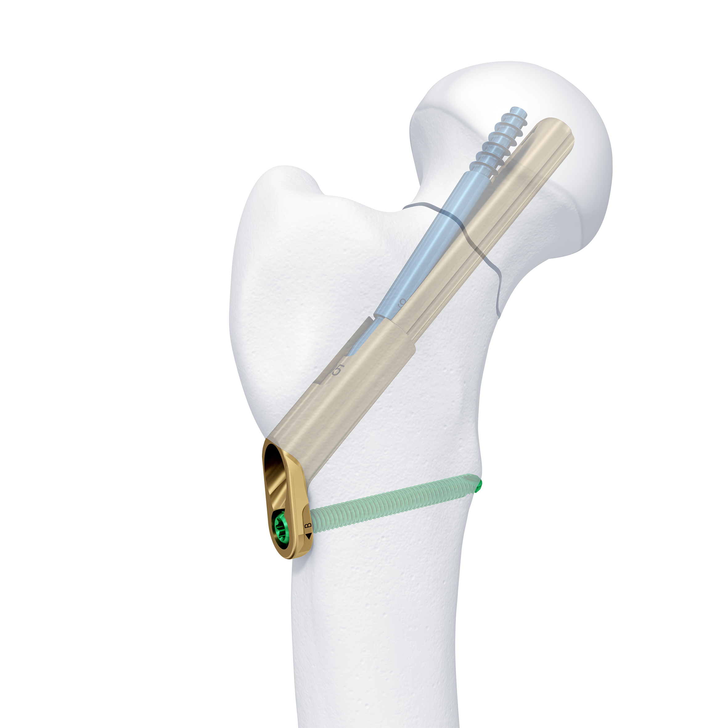 Femoral Neck System