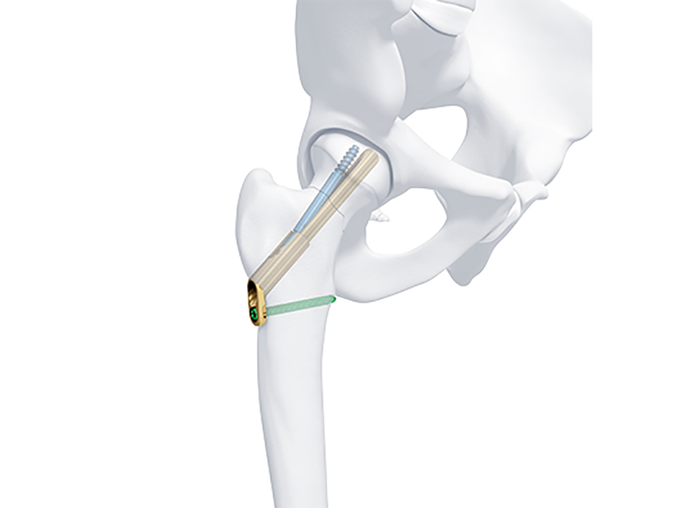 Femoral Neck System