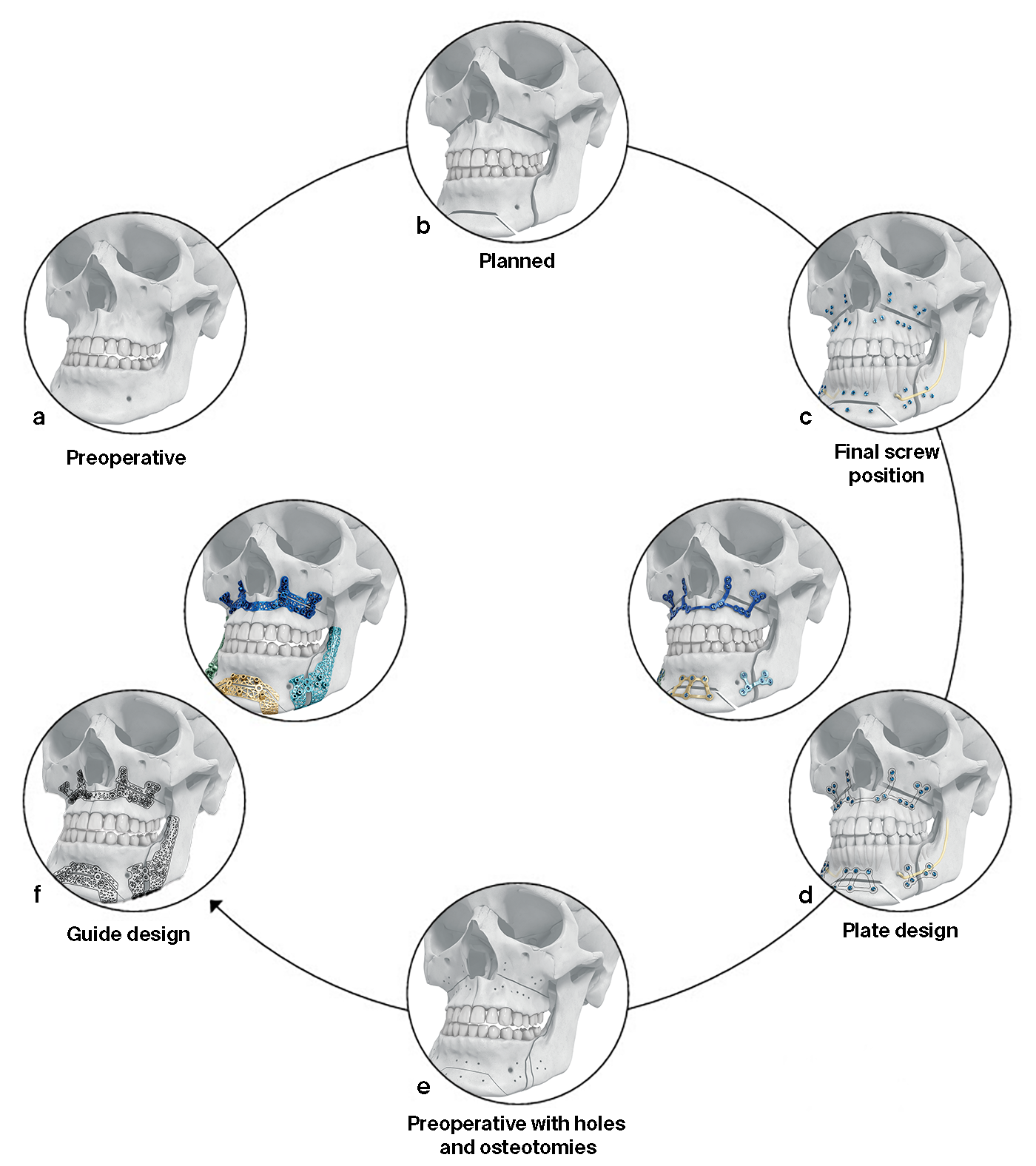 Patient Specific Orthognathic Plates