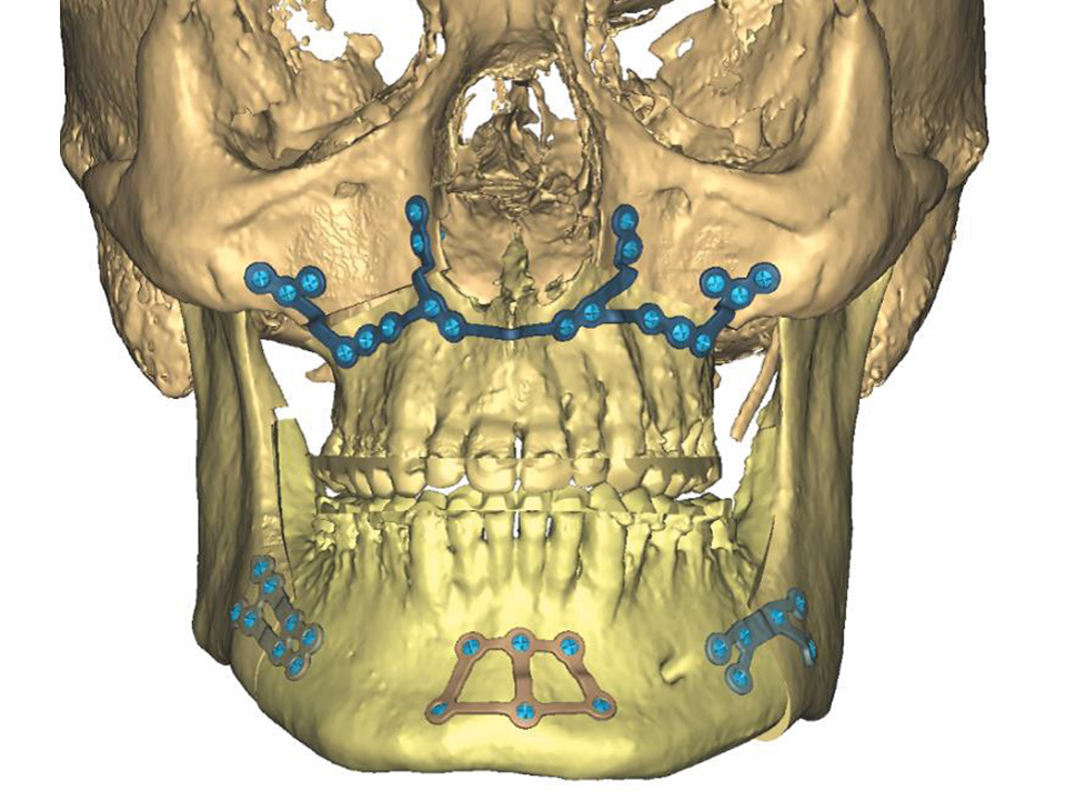Surgical technique guides and design guidelines for 3-D Patient ...