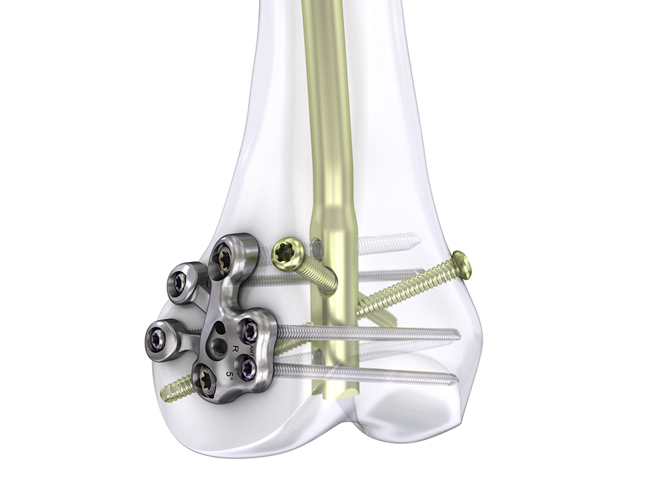 RFN-Advanced Retrograde Femoral Nailing System