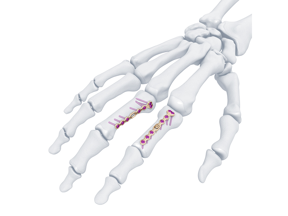 Variable Angle Locking Hand System