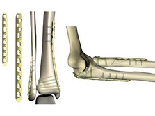 LCP Metaphyseal Plate 3.5, 4.5, and 5.0