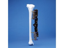 Adjustable Large External Fixator