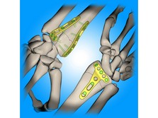 Locking Distal Radius System 2.4