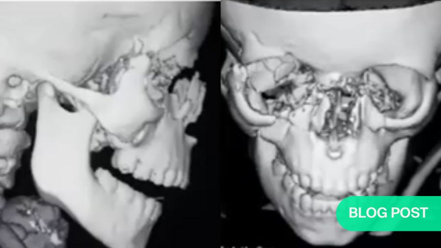 broken cheekbone child