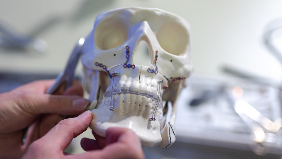 The maxilla-first approach in orthognathic treatment for predictable ...