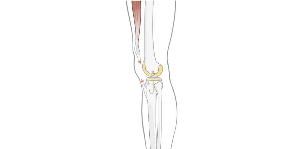 Extensor tendon rupture after total knee arthroplasty