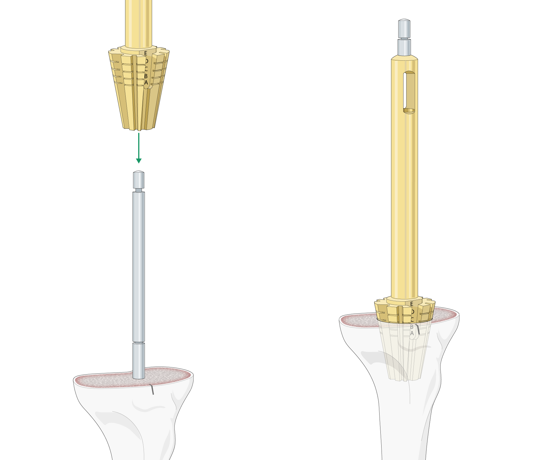 Surgical technique of metaphyseal sleeves and cones