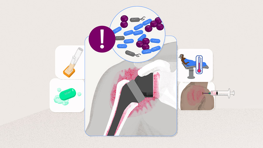 Preventing infection in reverse shoulder arthroplasty