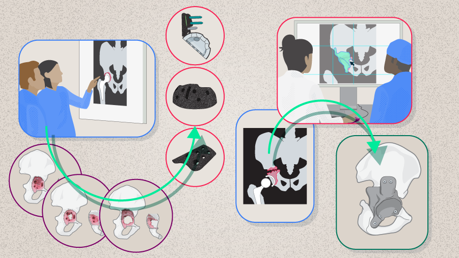 Acetabular Bone Defects Classification And Diagnosis