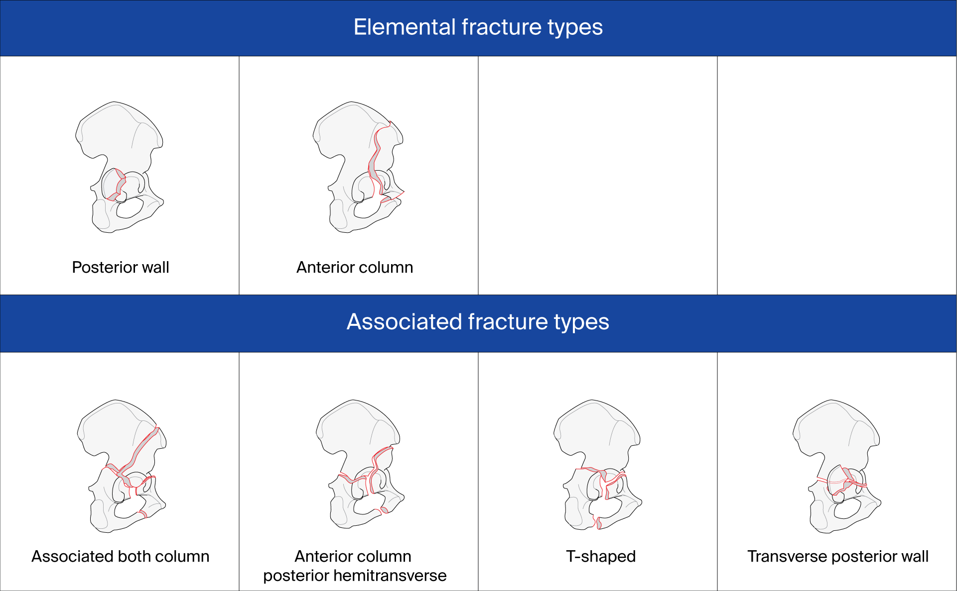 Types of acetabular fractures and their indications